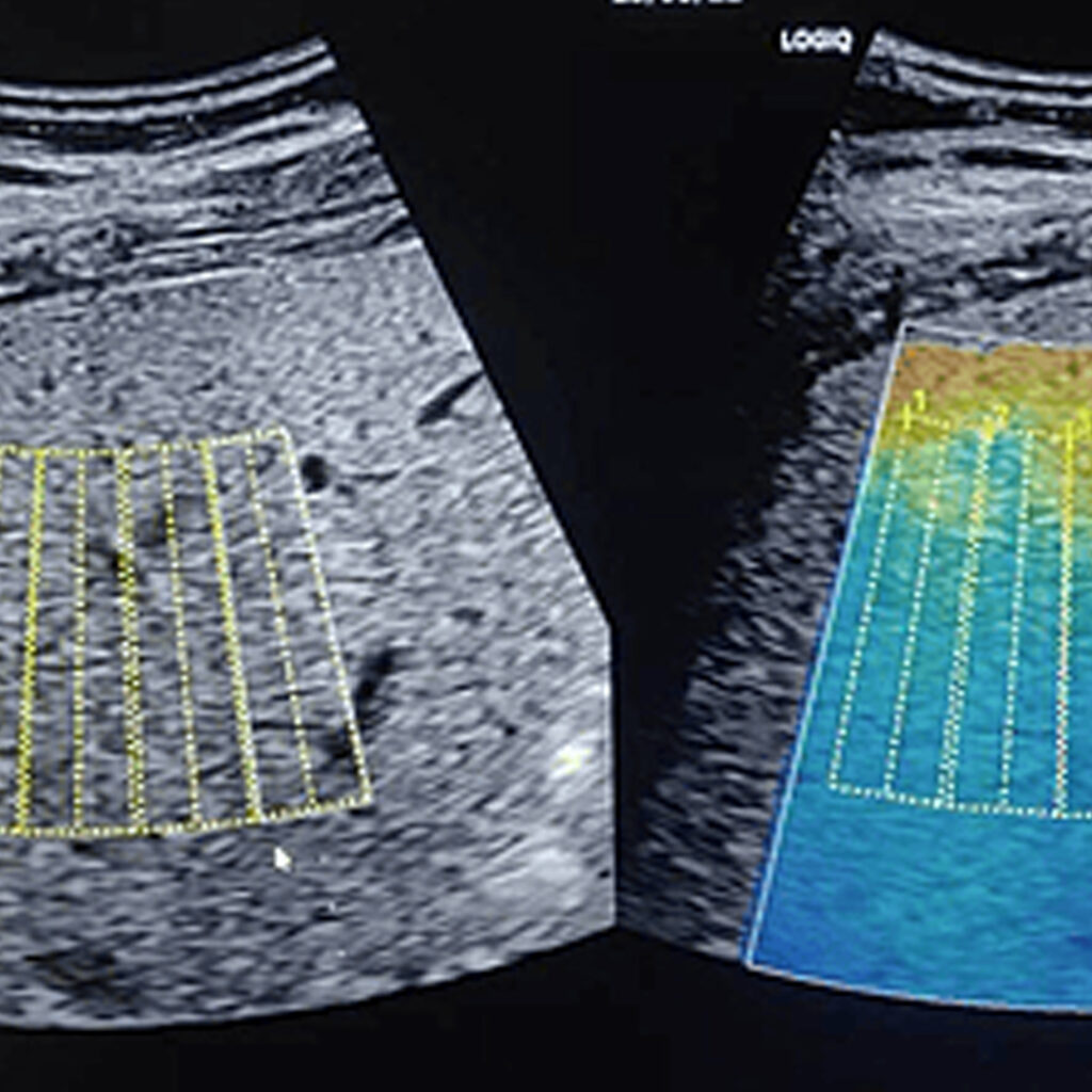 Fibroscan Liver Test – Zaina Diagnostic & Imaging Centre.